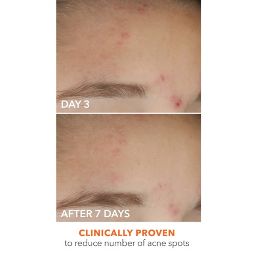 Dr Dennis Gross Alpha Beta® On The Spot Eliminator 30 ml | lyko.com